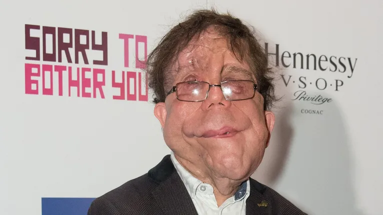 Adam Pearson Net Worth 2024: What Is The Actor Worth?